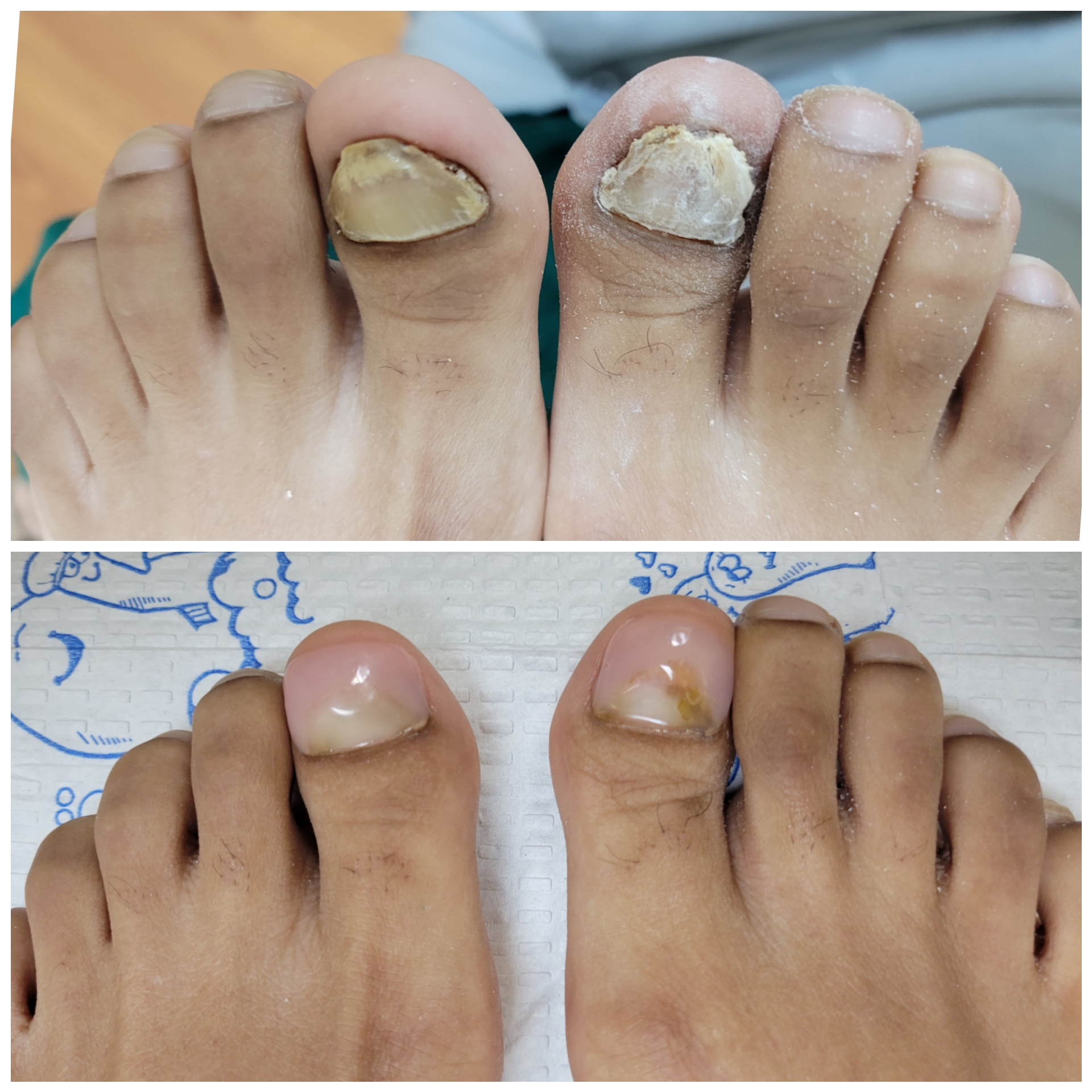KeryFlex Toenail Treatment Podiatry of Arlington Heights – Podiatry of ...